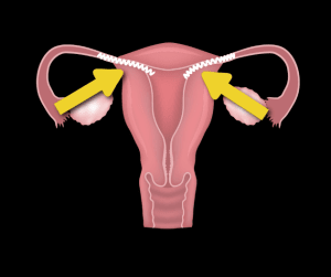 FDA’s Refusal to Remove Essure® From Market Sparks Outrage